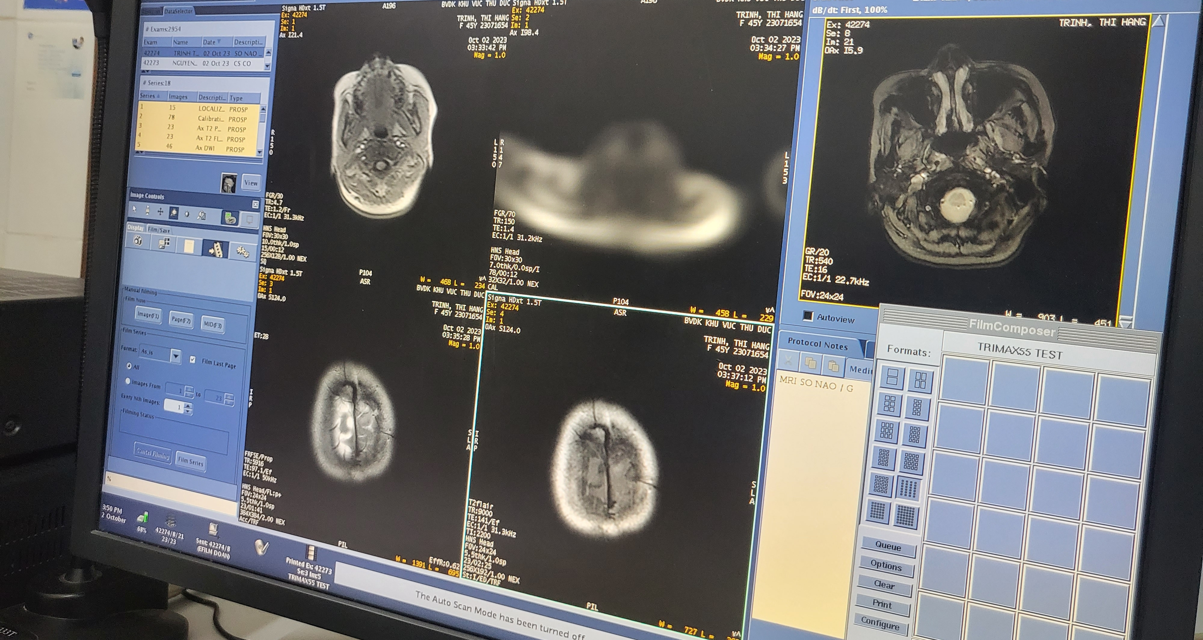 Máy MRI hỏng của Bệnh viện Ung bướu đã hoạt động lại từ hôm nay