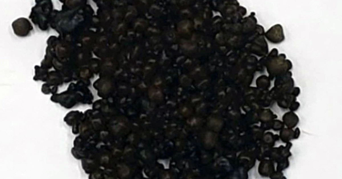 Hơn 400 viên sỏi trong túi mật người phụ nữ 44 tuổi