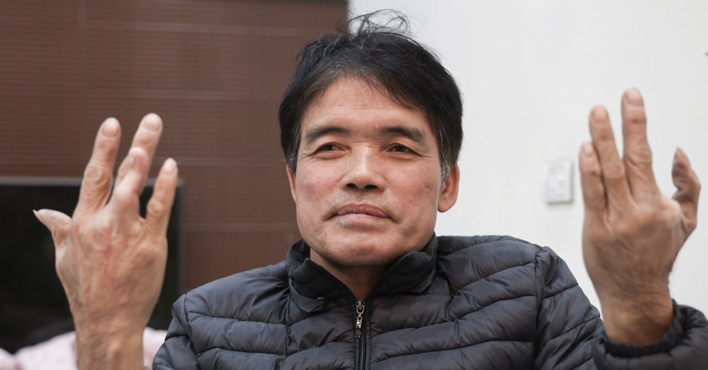 Đôi bàn tay thiếu ngón 'hé lộ' sự thật rợn người ở làng nuôi rắn hổ mang