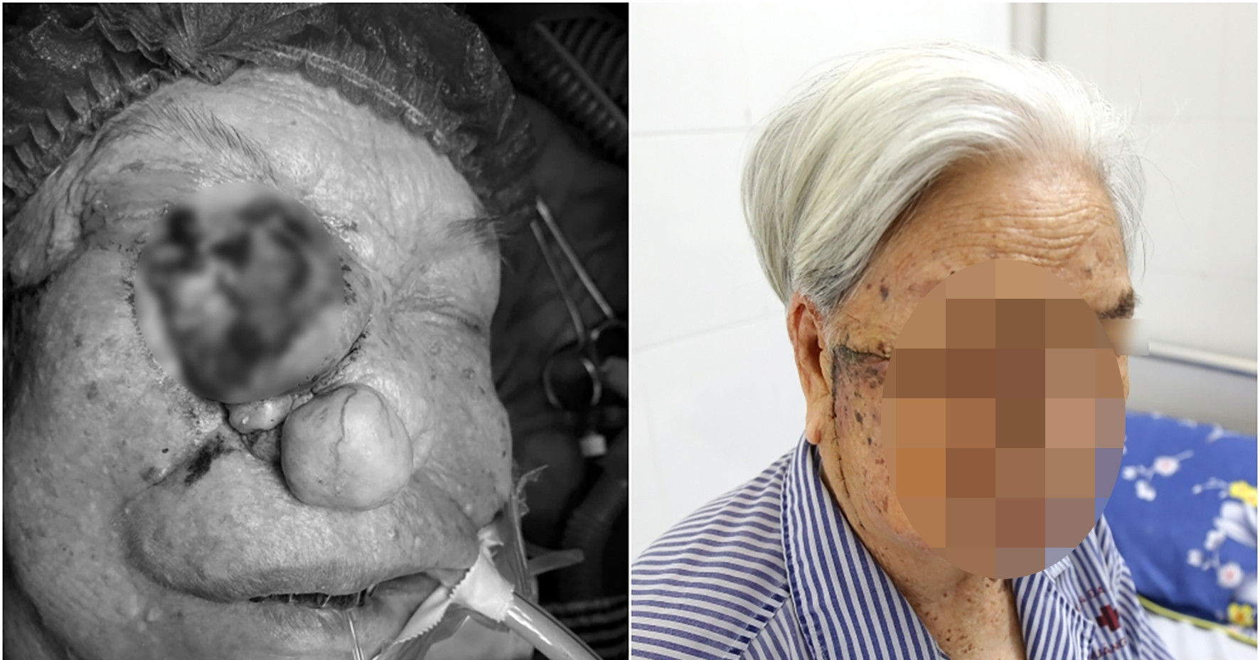 Doctors remove large facial tumor from 96-year-old patient