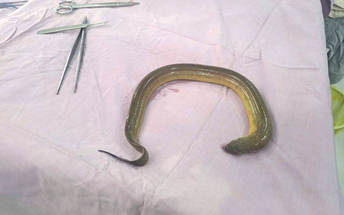 Doctors find 50cm eel inside man’s abdomen in rare emergency case